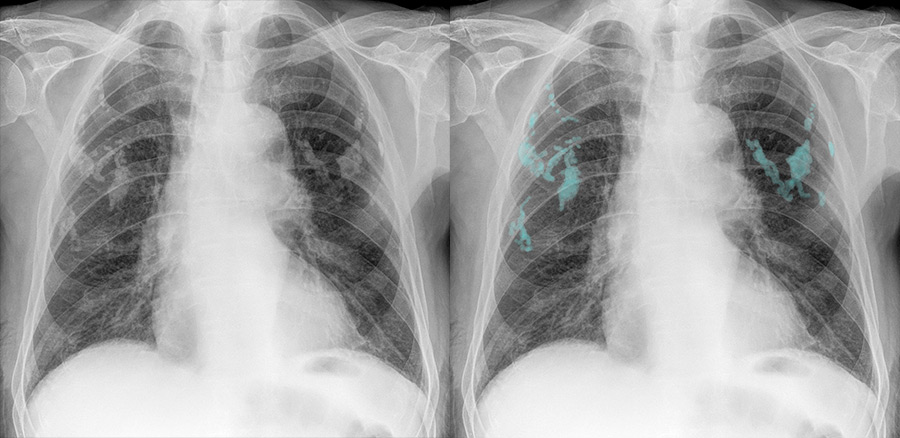 What Is Asbestos Pleural Effusion