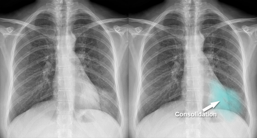 Pneumonia Chest X Ray Vs Normal - vrogue.co Pneumonia Chest X Ray Vs Normal - vrogue.co