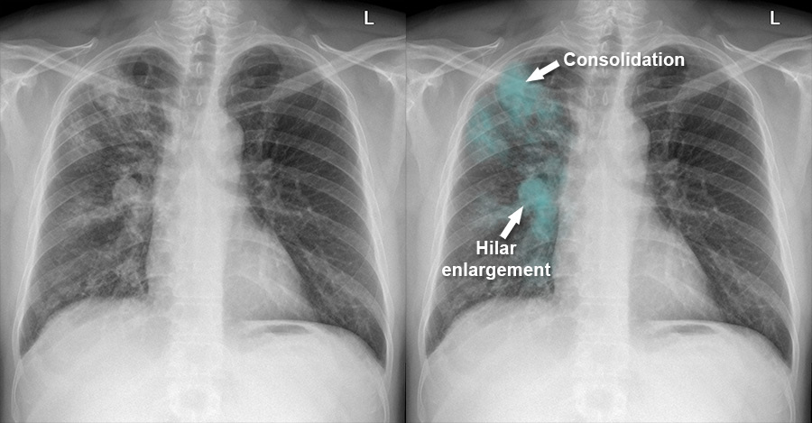 Deep Learning Classification Of Active Tuberculosis Lung, 57% OFF Deep Learning Classification Of Active Tuberculosis Lung, 57% OFF
