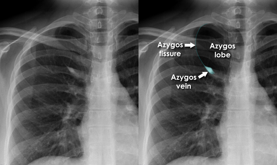 Chest X Ray Anatomical Variants at Evelyn Hampton blog