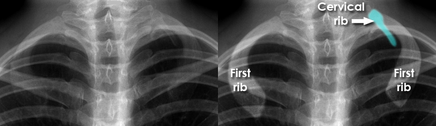 Rib Cage X Ray Drawing X Ray Rib Cage Vector Images 63 Download 15 Rib ...