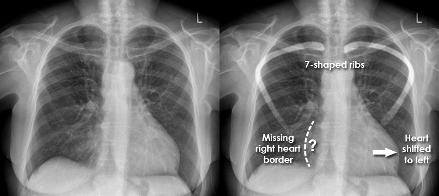 Pectus Excavatum