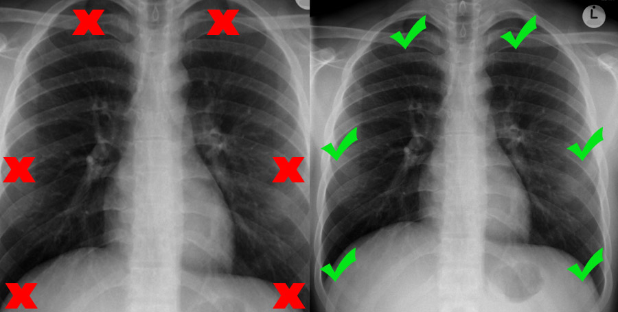 Chest X-ray Quality - Inclusion