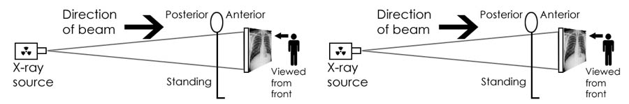 Chest X-ray Quality - Projection