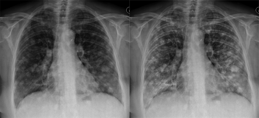 Ai Accurately Identifies Normal And Abnormal Chest X Rays 43 Off