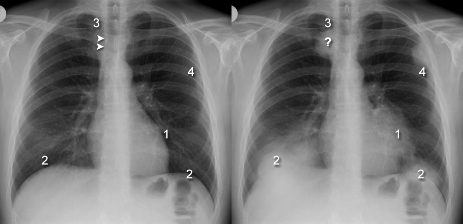 Chest X-ray Systematic Approach - Locating abnormalities