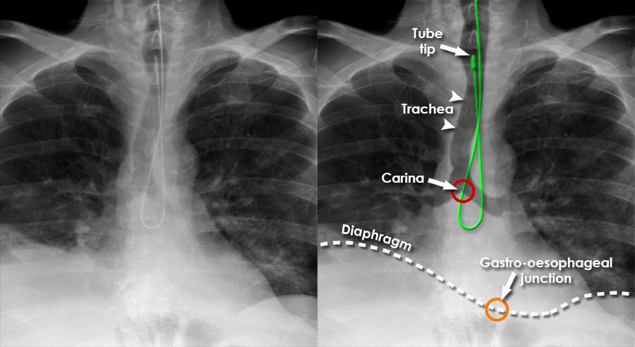 Nasogastric Tube Position On Chest X Ray Summary Radi