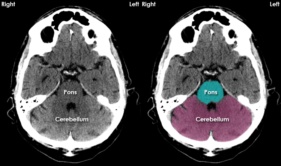 CT Brain Anatomy - Posterior fossa CT Brain Anatomy - Posterior fossa