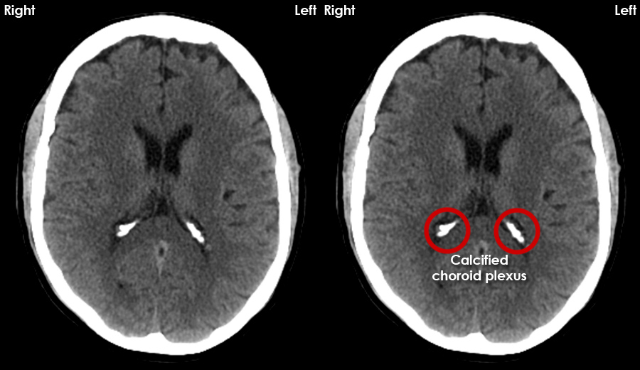 CT Brain Anatomy Calcified Structures CT Brain Anatomy Calcified Structures