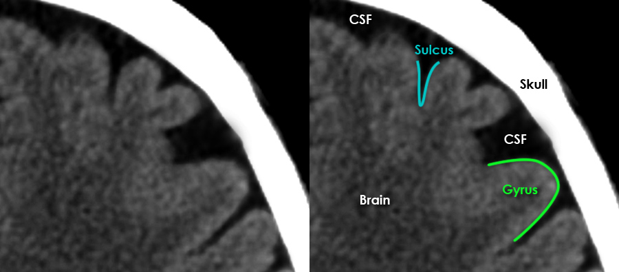 CT Brain Anatomy - CSF spaces