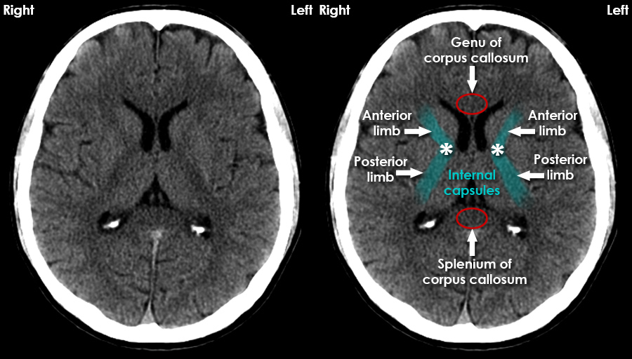 CT Brain Anatomy White Matter Structures CT Brain Anatomy White Matter Structures
