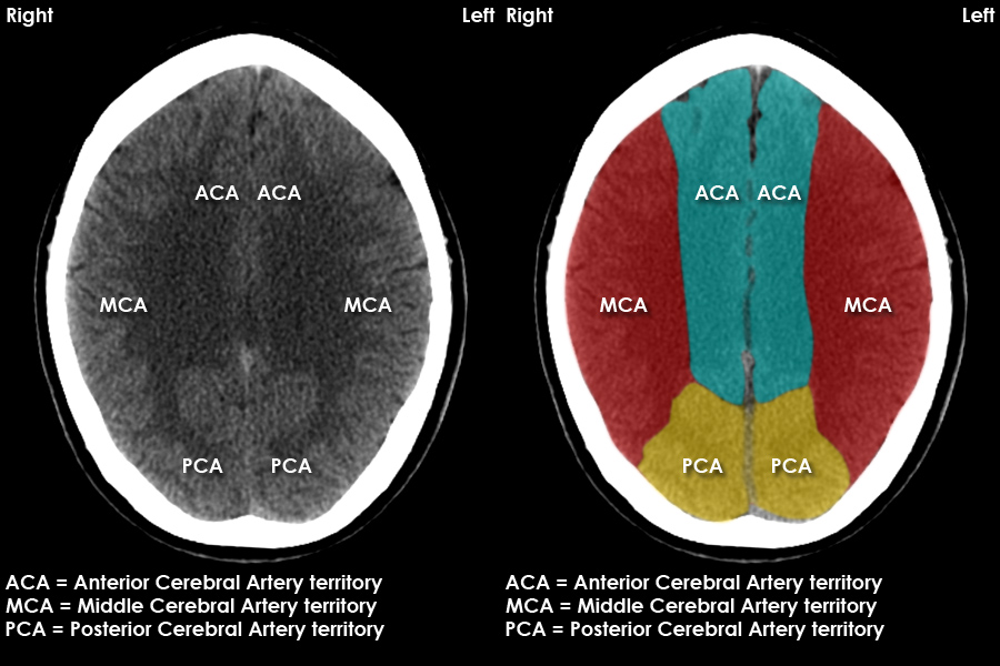 Posterior Cerebral Artery Distribution