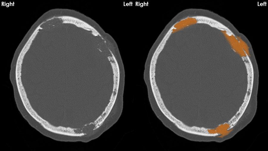 CT brain image gallery - Skull metastases