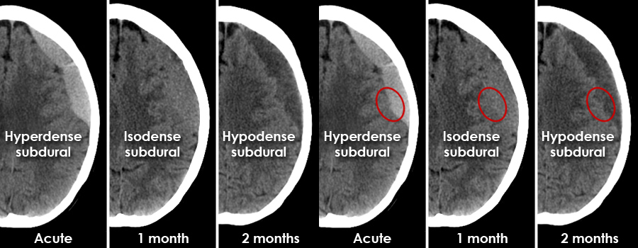 Ct Brain Image Gallery Sdh Acute V Chronic