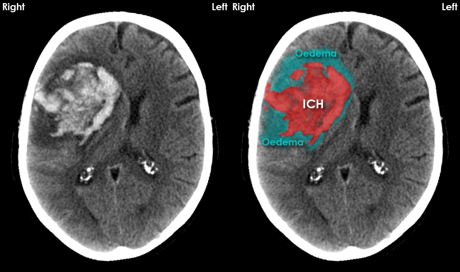 Ct Brain Image Gallery Ich