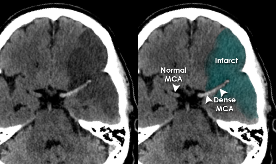 Ct Brain Image Gallery Infarct Acute V Chronic