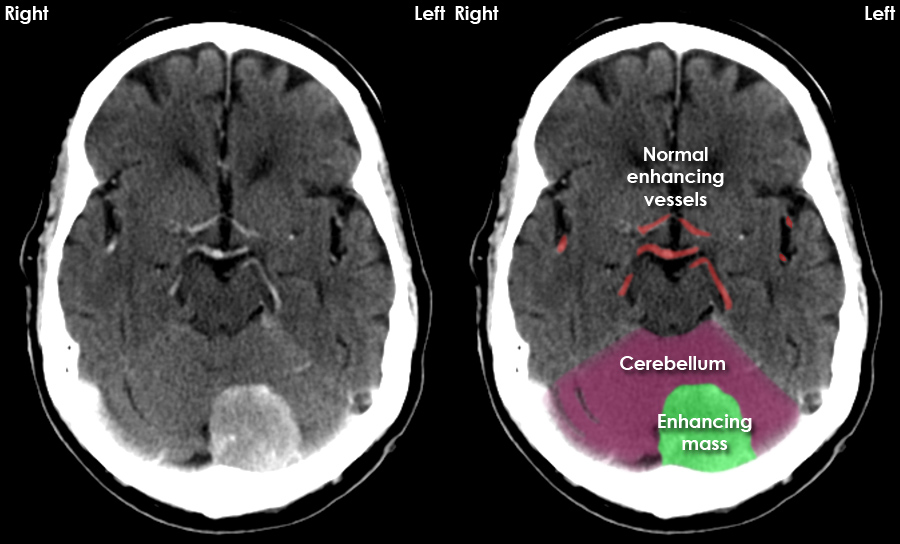 Ct Brain Image Gallery Meningioma