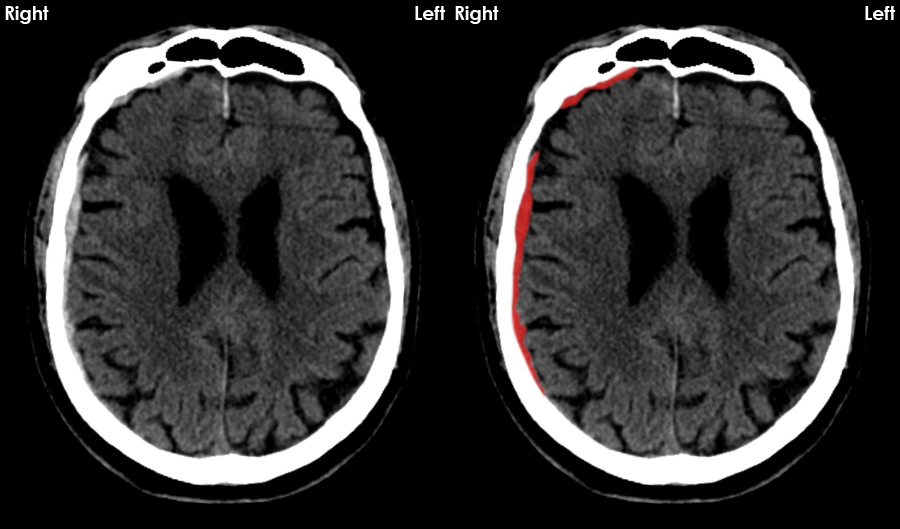 Ct Brain Image Gallery Sdh Small