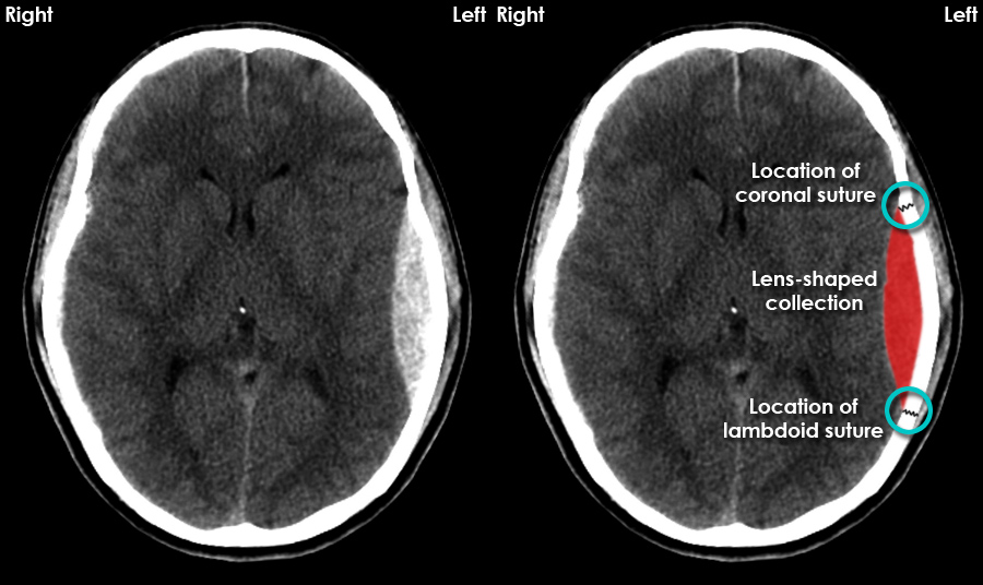 Epidural Hematoma Shape In Ct Epidural Hematoma Shape In Ct