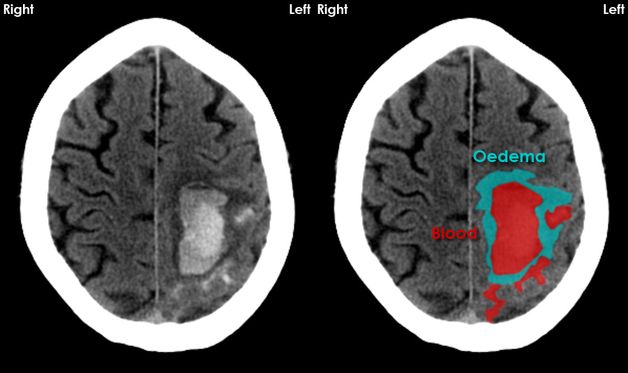 Pathology Of Intracerebral Hemorrhage Ich Primary Bra