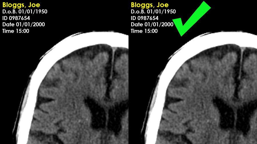 Ct Head Interpretation For Beginners Osce Guide 55 Off