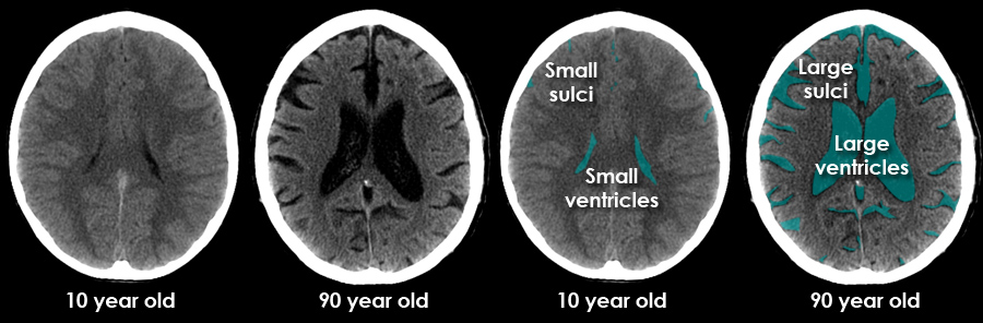 Acute Ct Brain Brain Volume