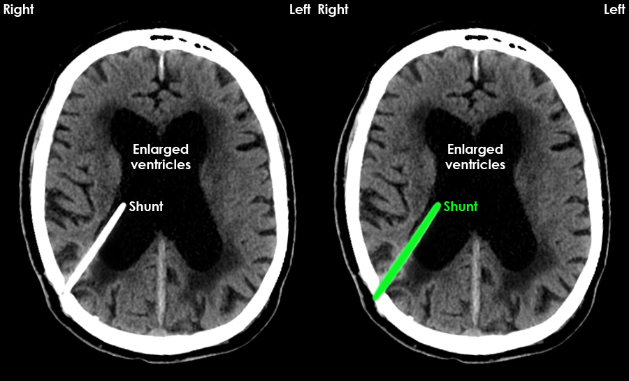 Acute Ct Brain Brain Ct Quality And Artifacts