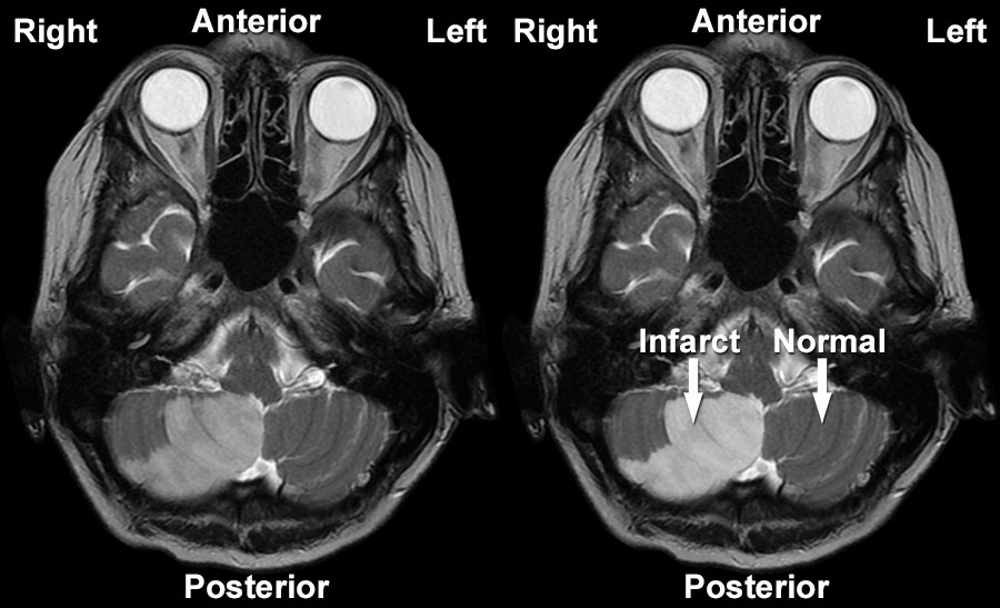 Mri Gallery Mri Brain Cerebellar Infarct