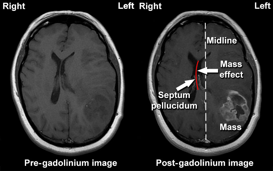 Mri Brain Tumor Glioblastoma