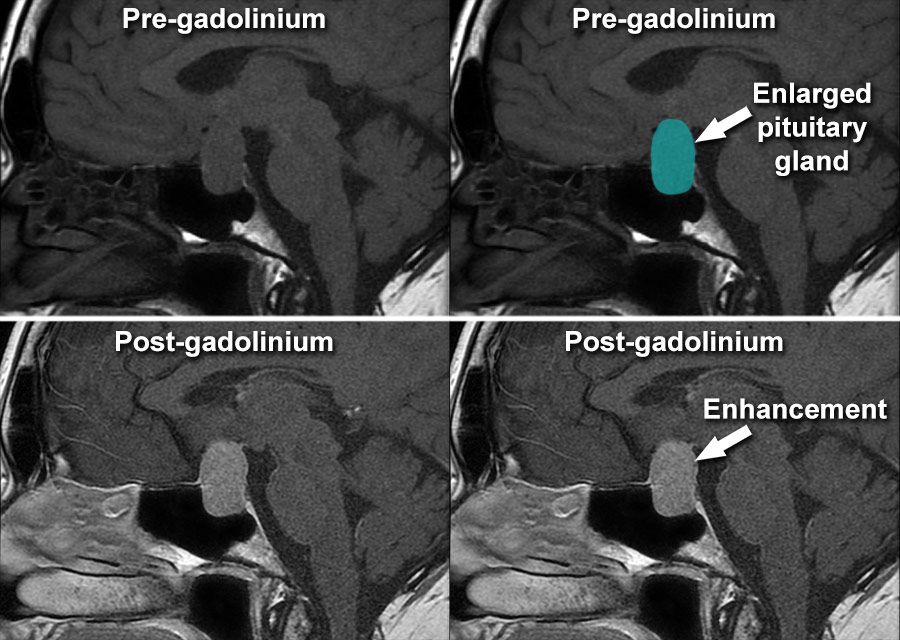 Pituitary Tumor Mri Pituitary Tumor Mri
