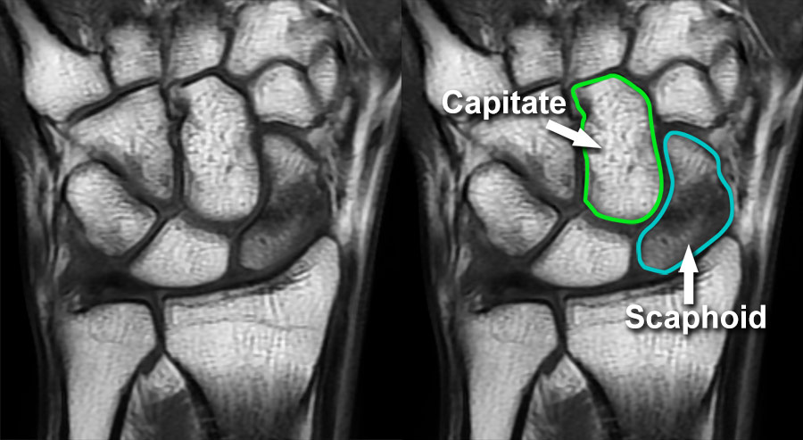 Scaphoid Fracture Radsource