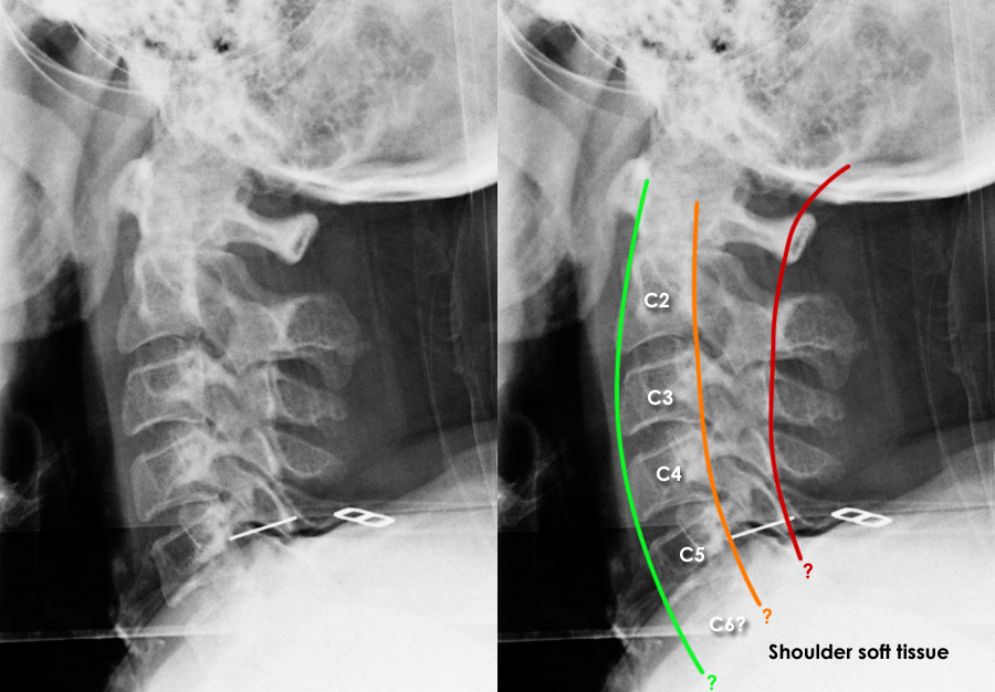 Trauma X-ray - Axial skeleton gallery 1 - Cervical spine - X-ray and CT