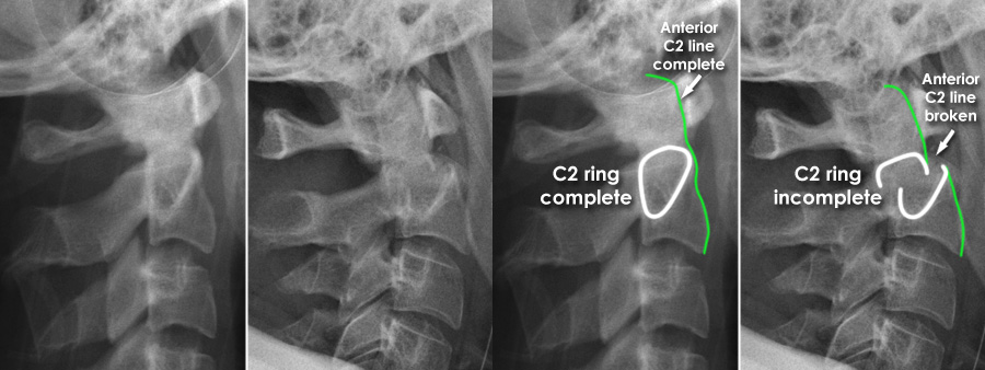 C2 Spine Fracture