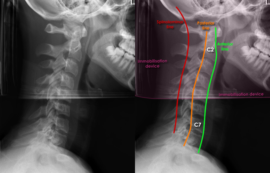 Lordosis X Ray