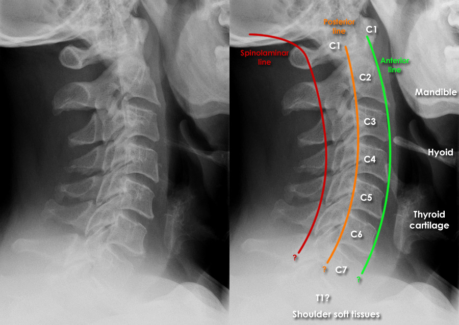 How To Read C-Spine X-Ray – International Emergency, 52% OFF How To Read C-Spine X-Ray – International Emergency, 52% OFF