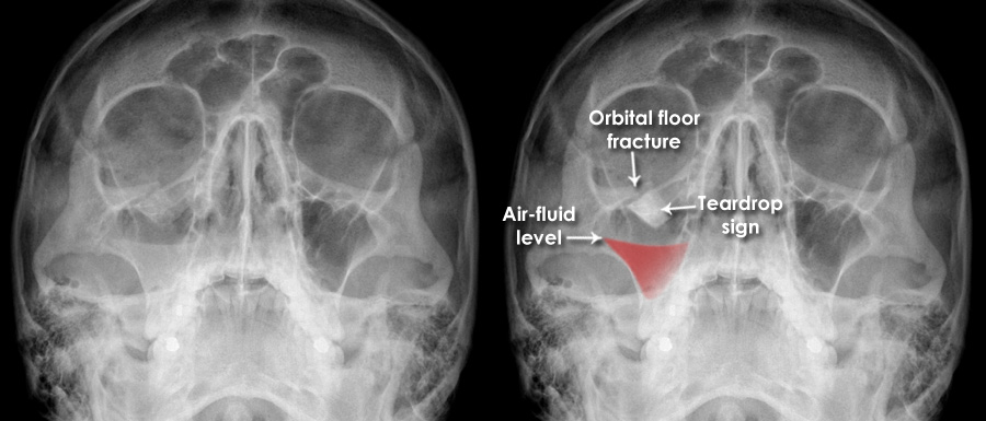 Orbital Fracture X Ray