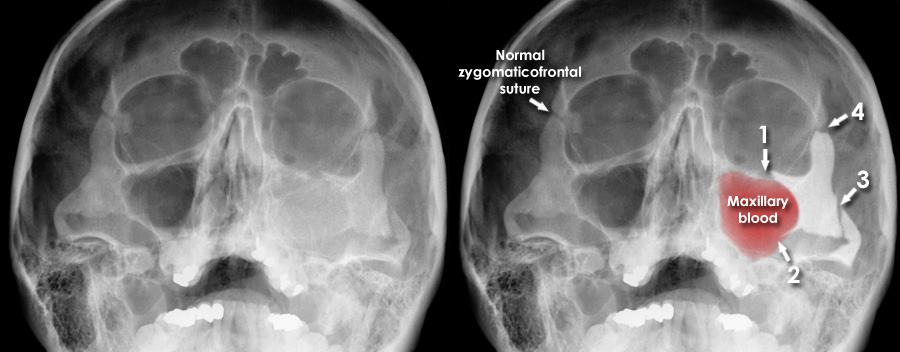Blowout Fracture X Ray