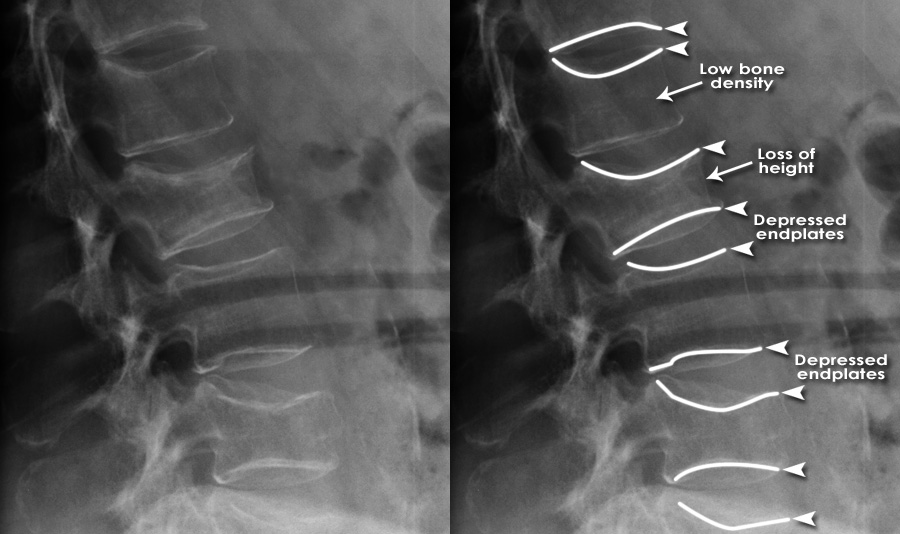 Pathological Fracture Spine