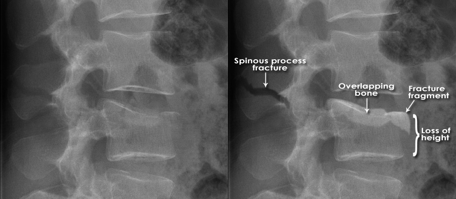Trauma X-ray - Axial skeleton gallery 2 - Lumbar spine - 'Chance-type ...