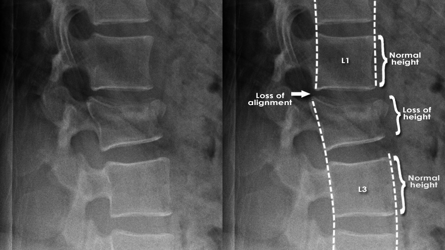 Trauma X-ray - Axial skeleton gallery 2 - Lumbar spine - Fracture stability