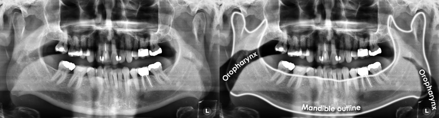 Trauma X-ray - Axial skeleton gallery 1 - Mandible fracture