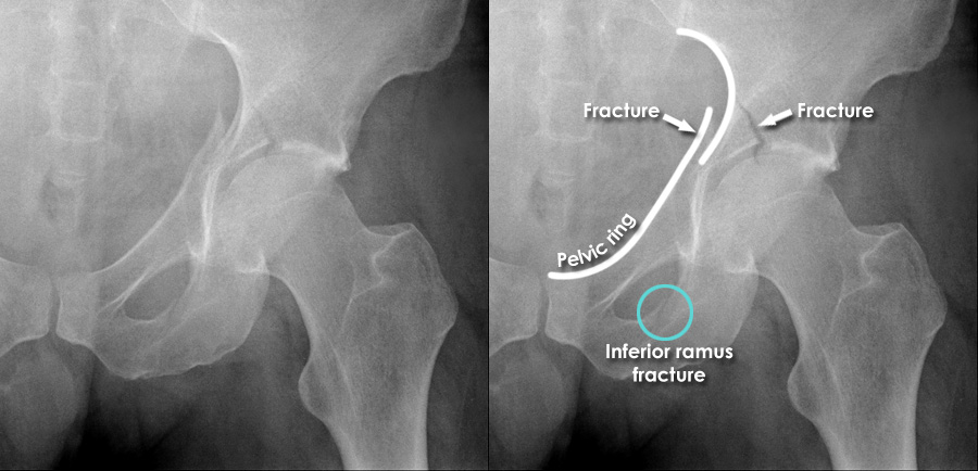 Pelvic Fracture X Ray