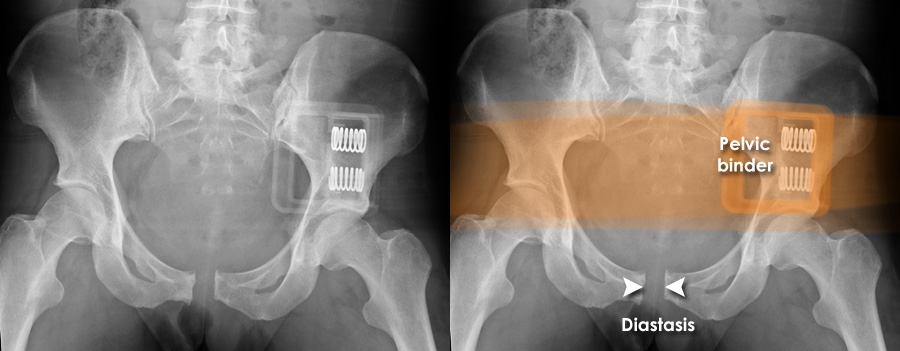 Trauma X-ray - Axial skeleton gallery 2 - Pelvis - Pelvic diastasis