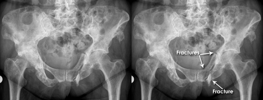 Trauma X-ray - Axial skeleton gallery 2 - Pelvis - Pathological fracture