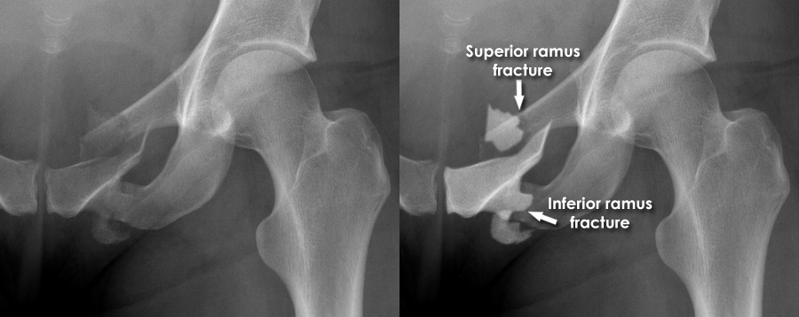 Superior Pubic Ramus Fracture