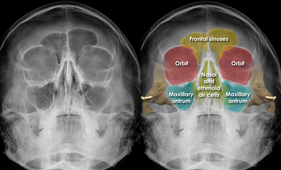 Trauma X ray Axial Skeleton Face trauma-x-ray-axial-skeleton-face