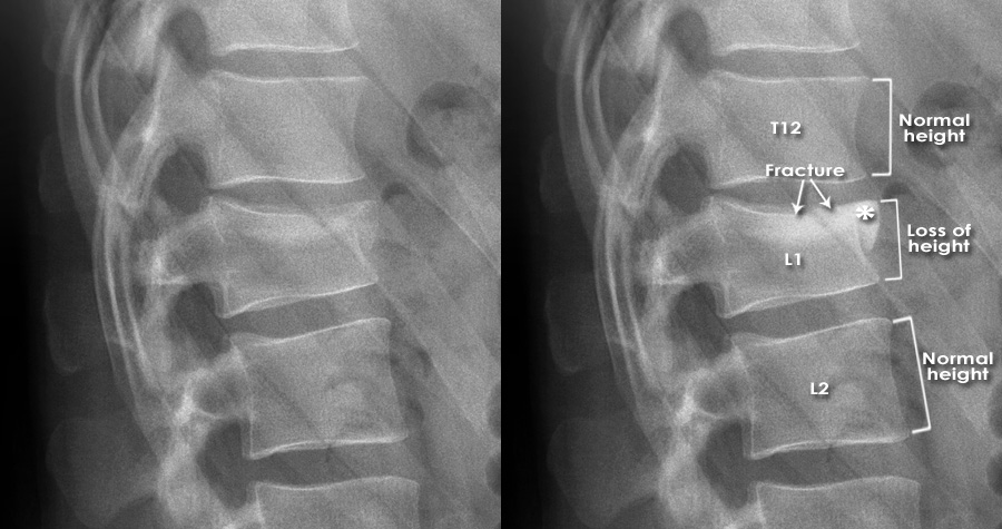 Compression Fracture Compression Fracture