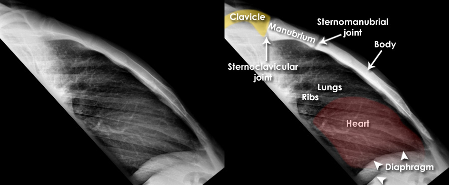 Trauma X-ray - Axial skeleton - Sternum