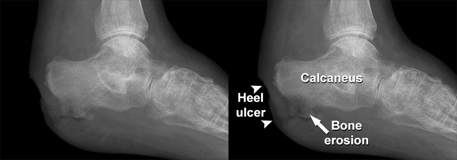 Osteomyelitis Mri Foot