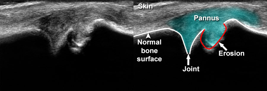 Imaging Of Musculoskeletal Disorders Rheumatoid Arthritis